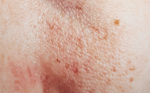 Five Ways to Reduce Textured Skin – DRMTLGY