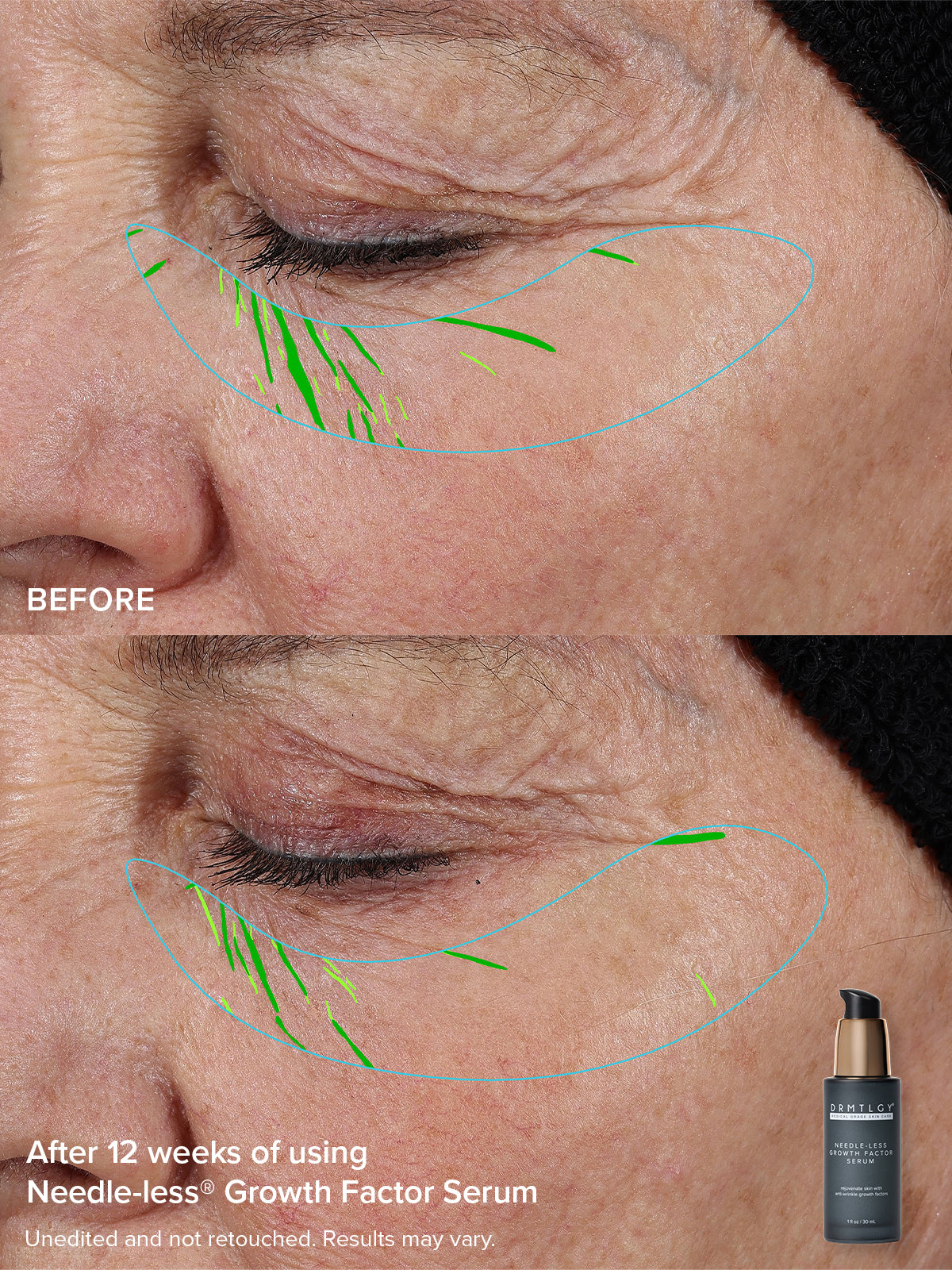 Meet the Needle-less® Duo – DRMTLGY